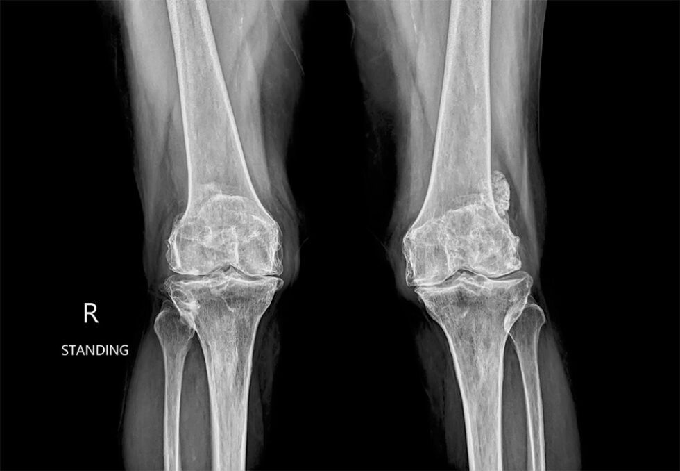 MRI (Magnetic Resonance Imaging): For detailed soft tissue imaging CT (Computed Tomography ...